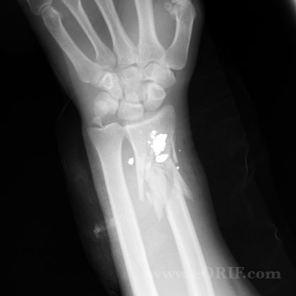 Distal Radius External Fixation 20690 | eORIF