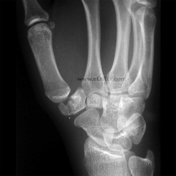 Trapezium Fracture