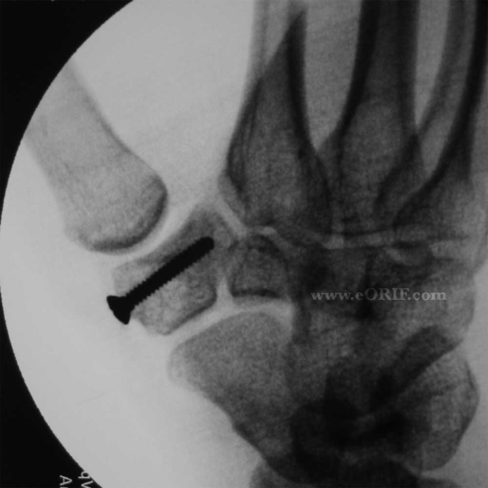Trapezium Fracture S62.173A 814.05 | eORIF