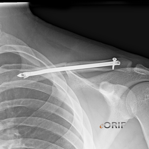 Clavicle Fracture ORIF Sonoma Nail EORIF