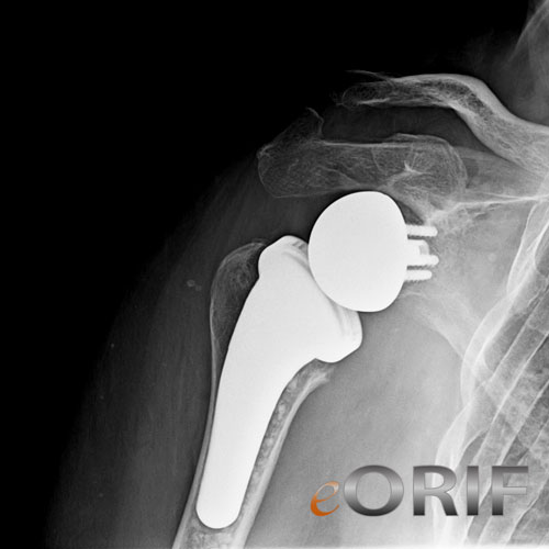 Reverse Total Shoulder Arthoplasty Cases EORIF Reverse Total Shoulder Arthoplasty Cases EORIF
